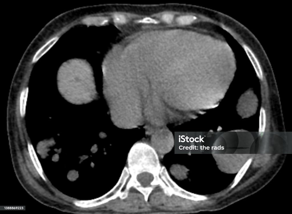 Bola Meriam Jenis Metastasis Paru Ct Scan Dada Foto Stok Unduh Gambar