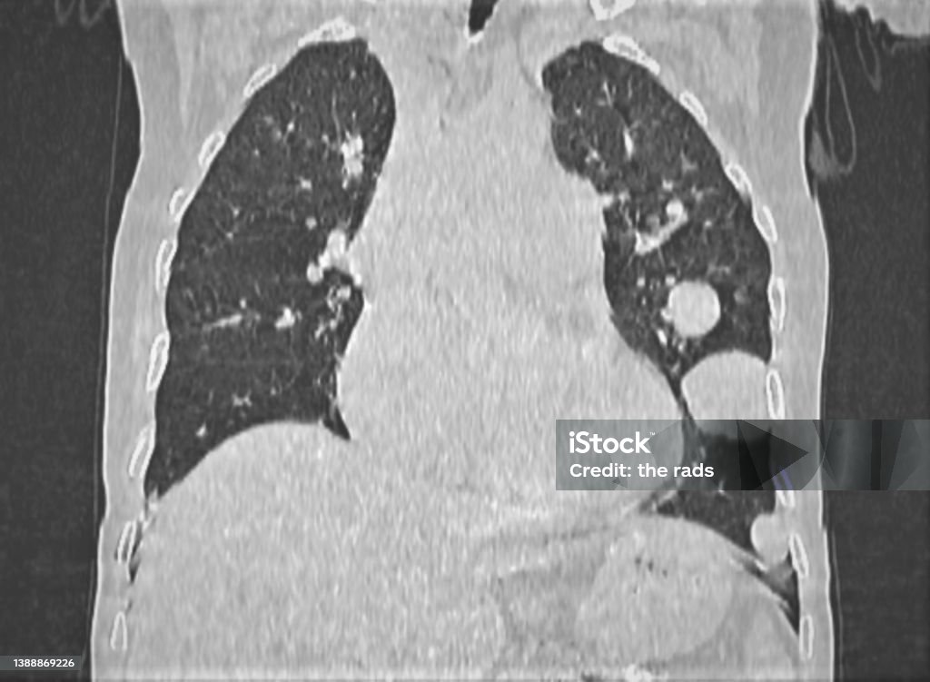 Bola Meriam Jenis Metastasis Paru Ct Scan Dada Foto Stok Unduh Gambar