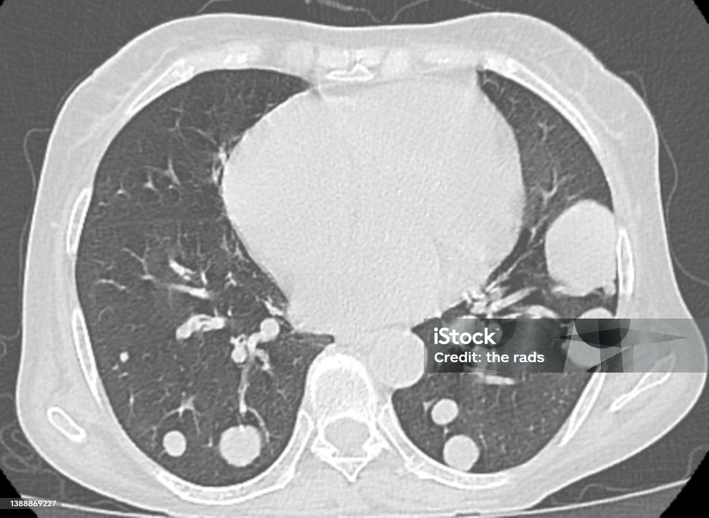 Bola Meriam Jenis Metastasis Paru Ct Scan Dada Foto Stok Unduh Gambar Sekarang Kanker Paru
