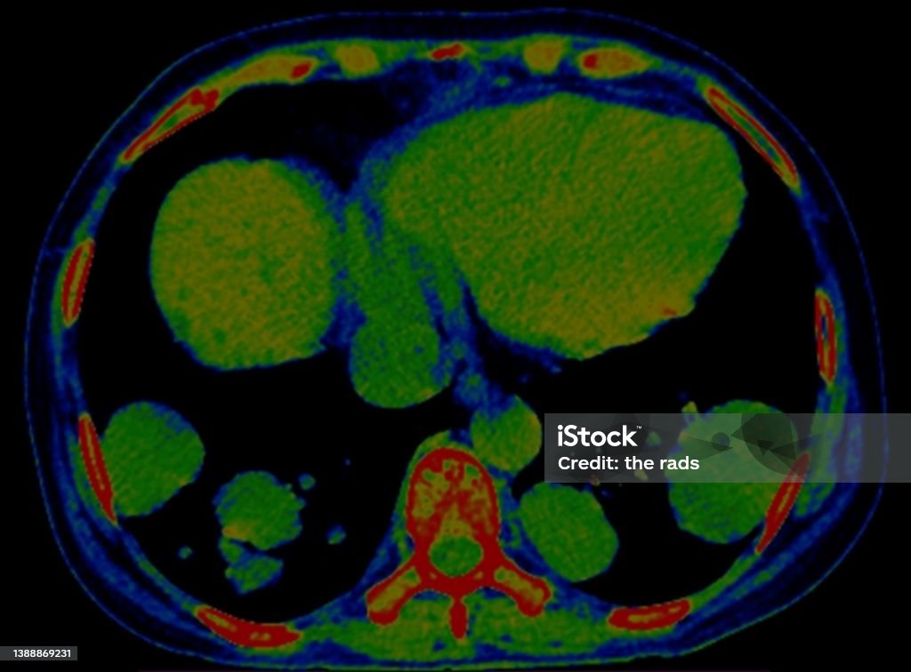 Bola Meriam Jenis Metastasis Paru Ct Scan Dada Foto Stok Unduh Gambar