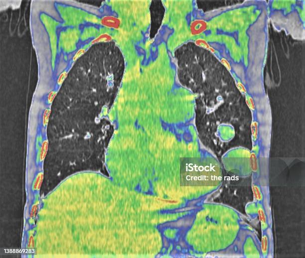 Bola Meriam Jenis Metastasis Paru Ct Scan Dada Foto Stok Unduh Gambar