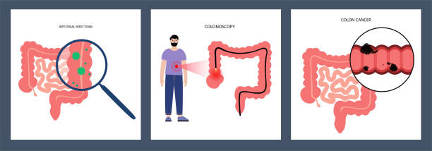 1 000 Colorectal Cancer Stock Illustrations Graphiques Vectoriels