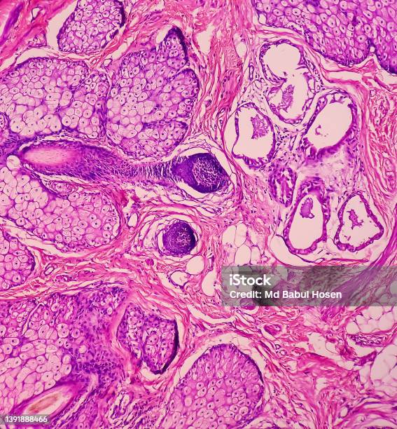 Ovarian Cyst Cystic Teratoma Microscopic Show Skin Adenexal Structure