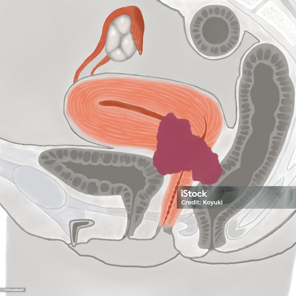 Illustration Of Stage Ⅳb Cervical Cancer Endstage Cervical Cancer Stock