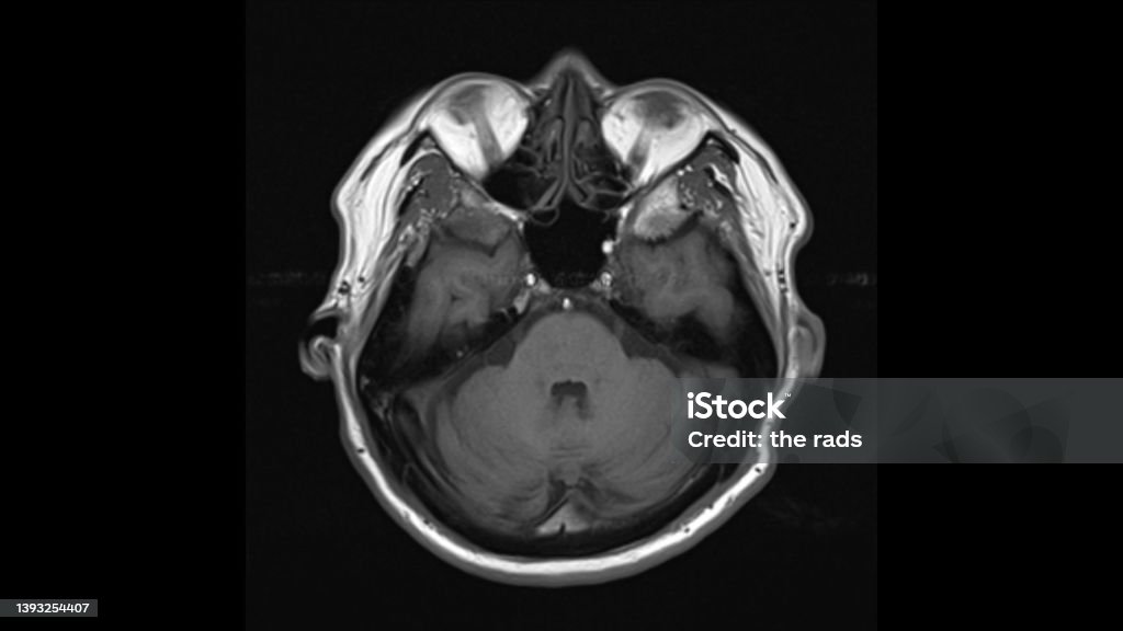 Cerebellum Anatomy Mri