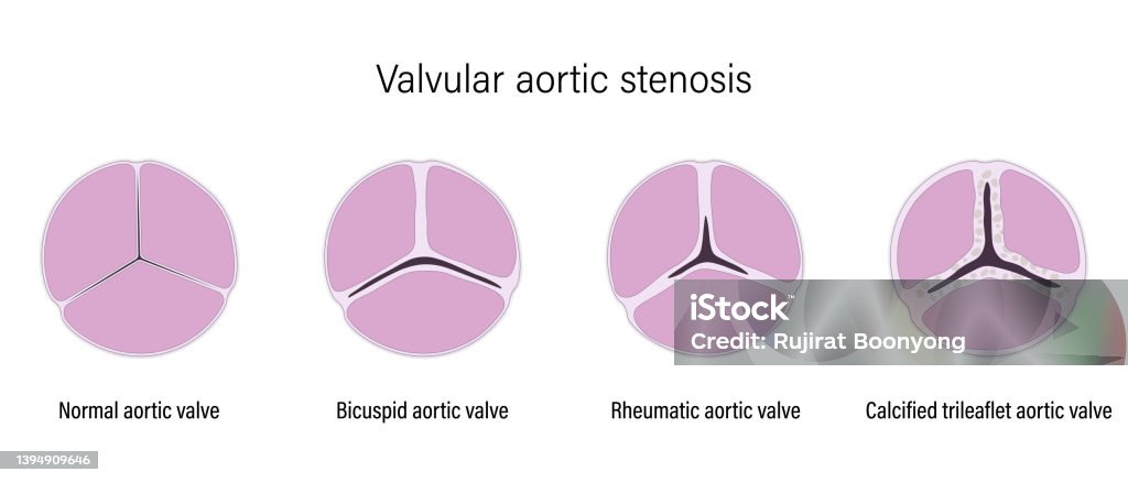 Valvular Aortic Stenosis Normal Aortic Valve Bicuspid Aortic Valve ... Valvular Aortic Stenosis Normal Aortic Valve Bicuspid Aortic Valve ...