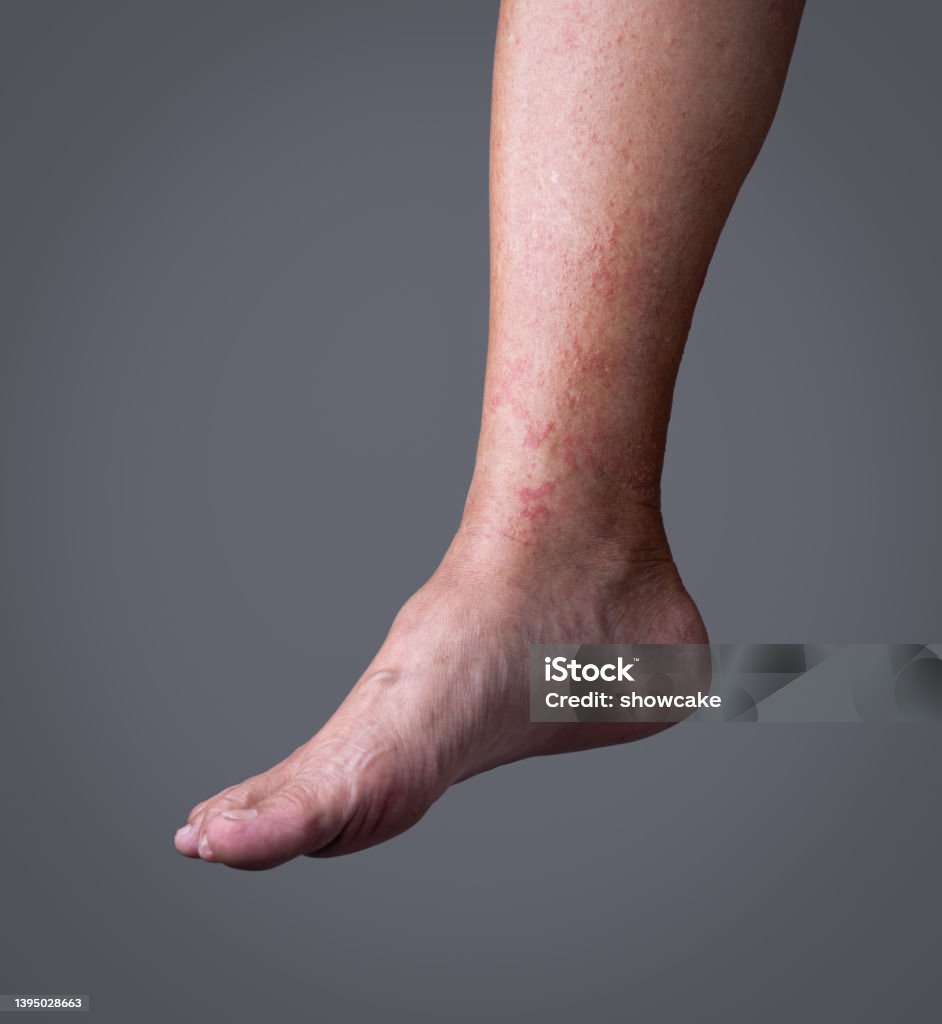 Strong Allergic Rashes On The Leg On Gray Background Dermatological Rash On The Skin And Body