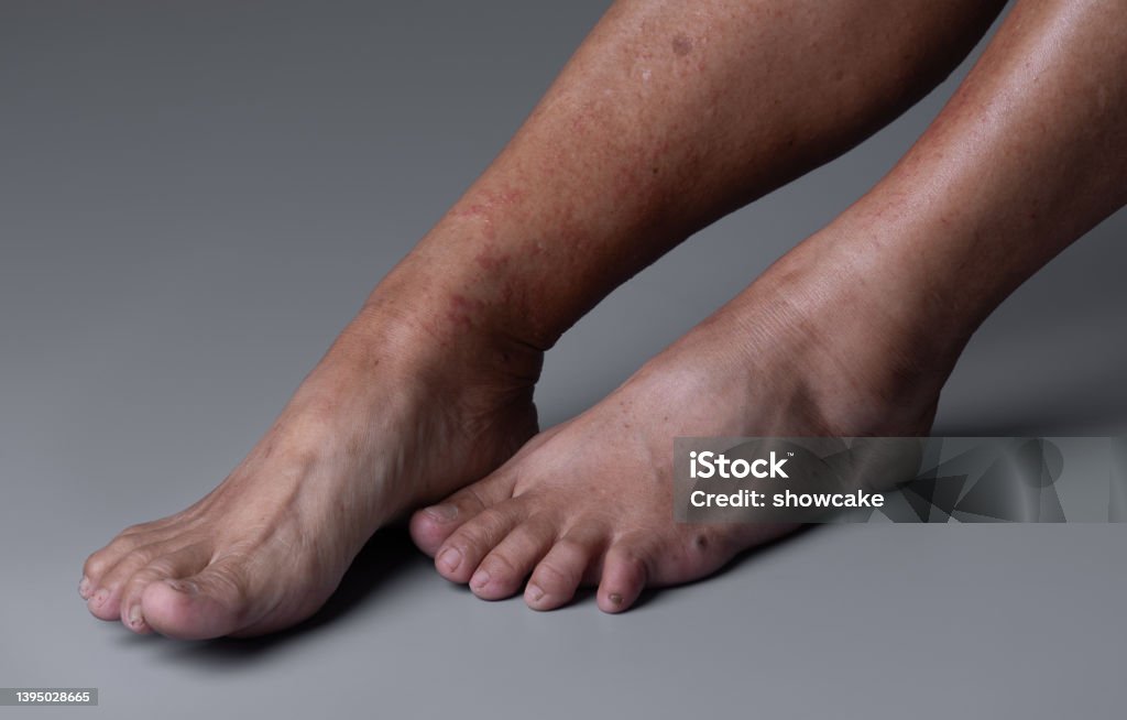 Strong Allergic Rashes On The Leg On Gray Background Dermatological Rash On The Skin And Body