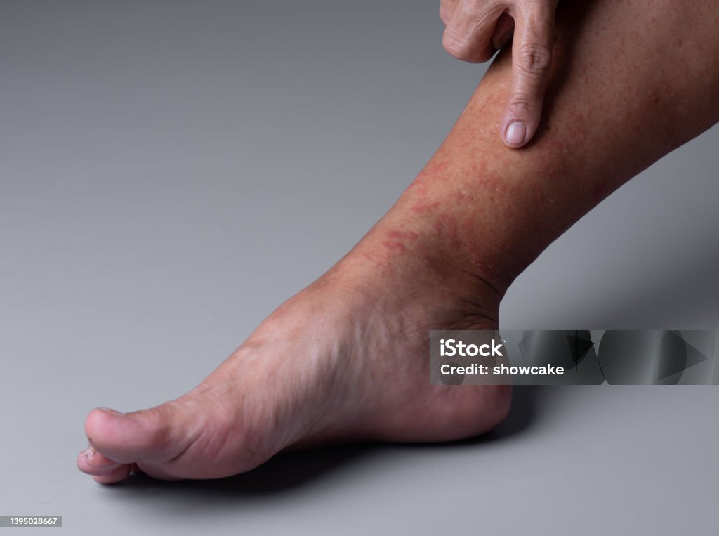 Strong Allergic Rashes On The Leg On Gray Background Dermatological Rash On The Skin And Body