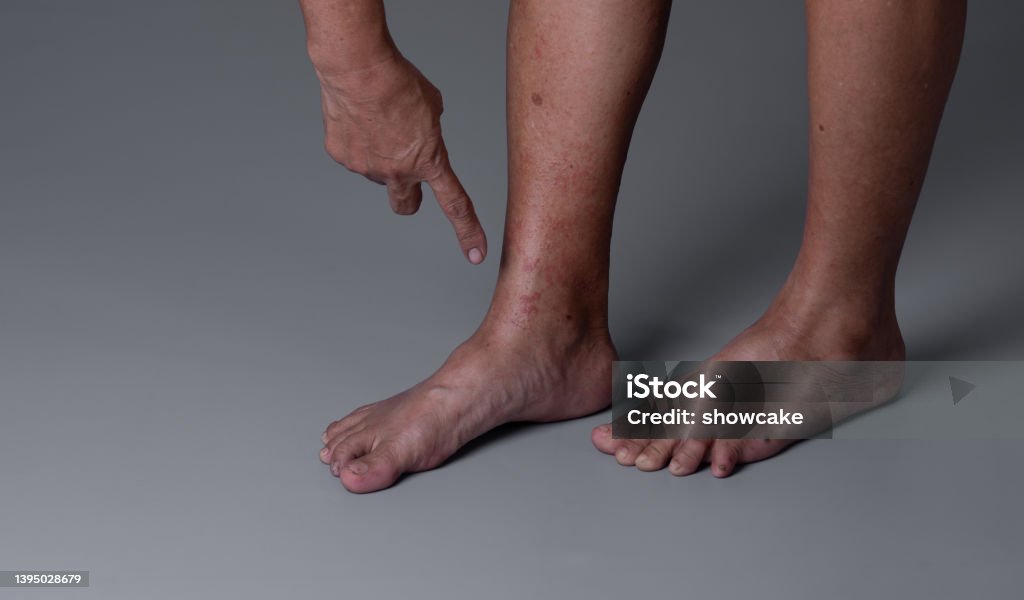 Strong Allergic Rashes On The Leg On Gray Background Dermatological Rash On The Skin And Body