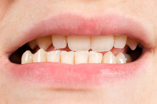Patient With Dislocated Jaw And Malocclusion Temporomandibular Joint