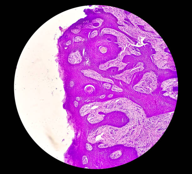 340 Carcinoma Basocelular Fotografías De Stock Fotos E Imágenes