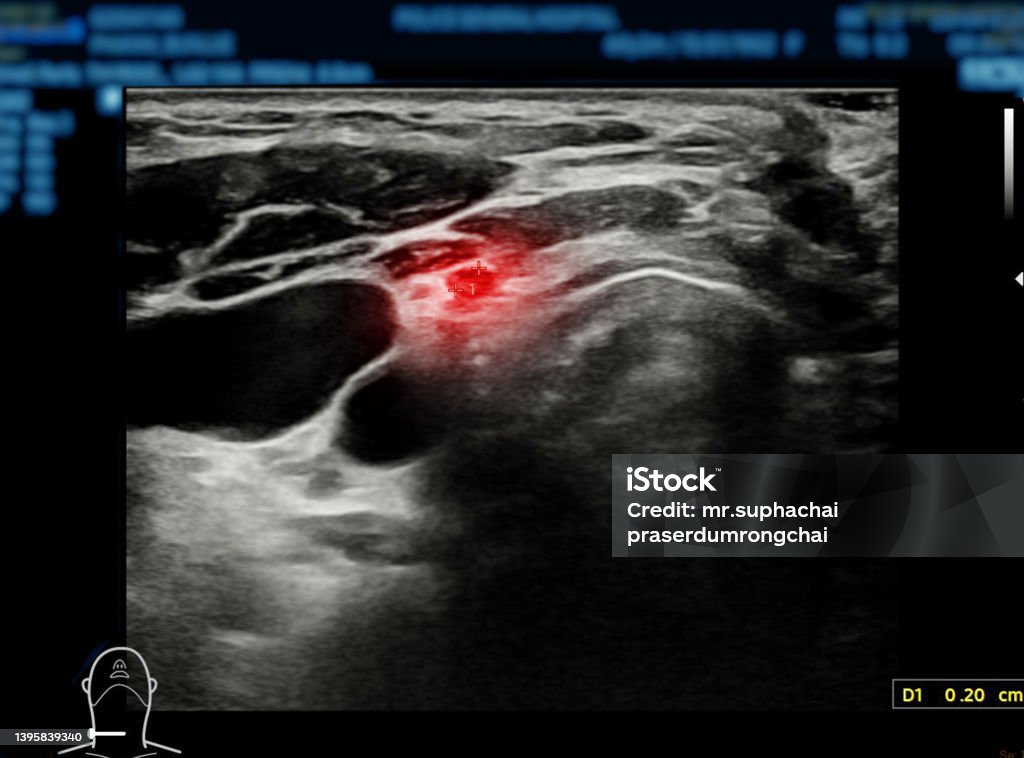 Ultrasonography Of Thyroid Gland For Diagnostics Of The Thyroid Gland