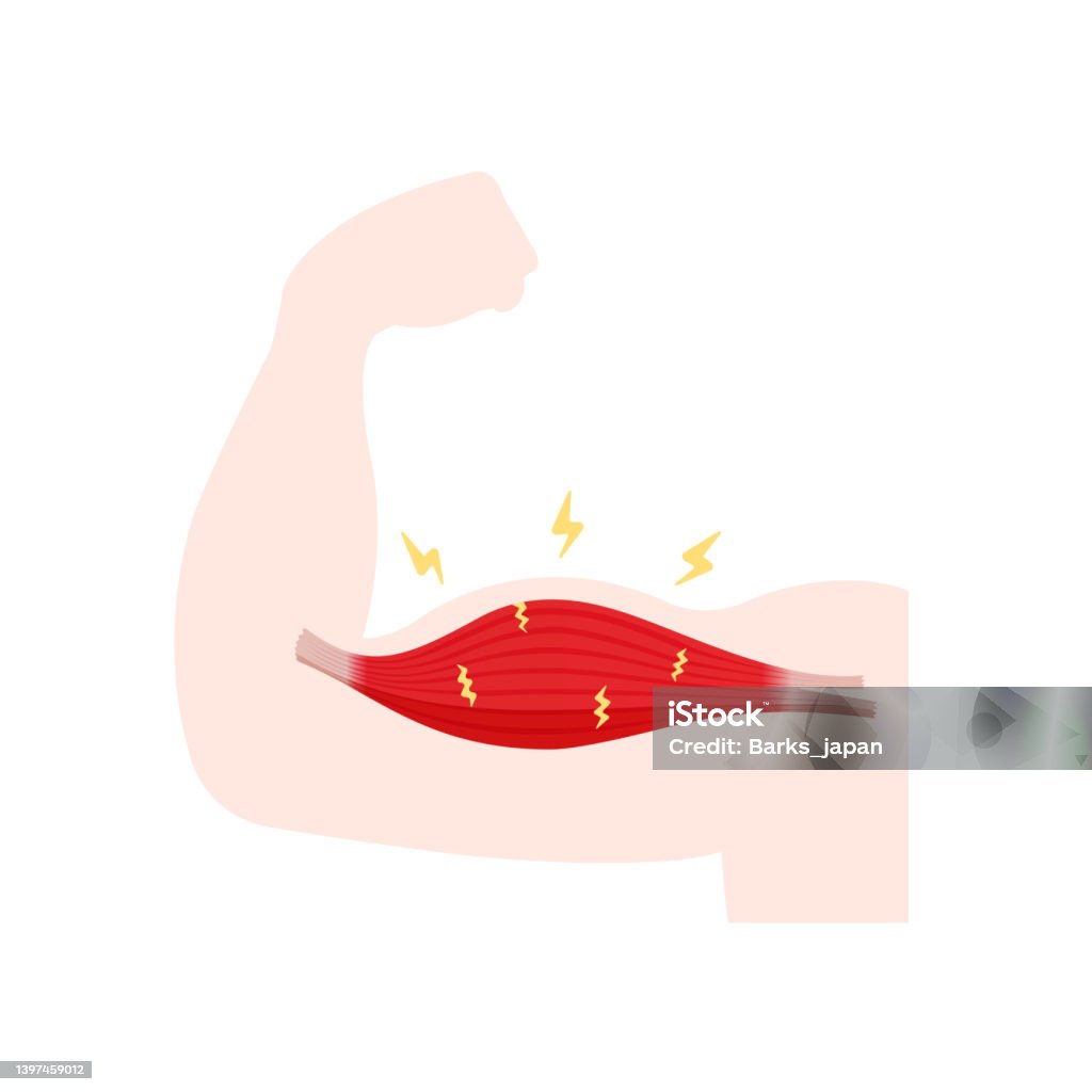 Illustration Vectorielle De Lésions Musculaires Vecteurs Libres De Droits Et Plus Dimages