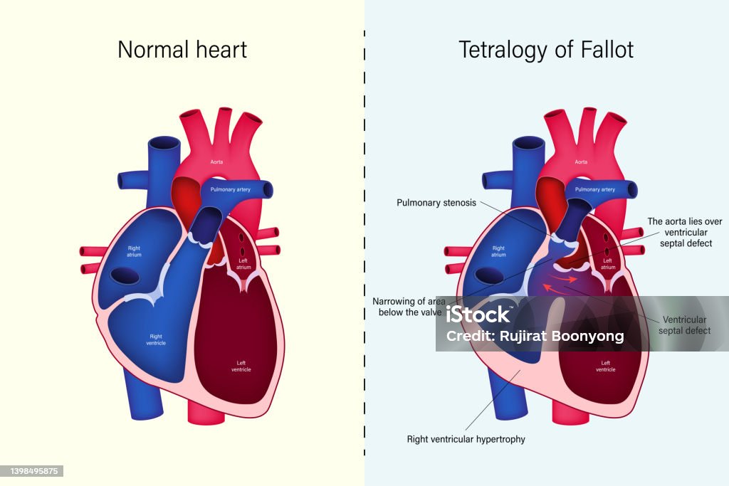 Congenital Heart Defects Diagram