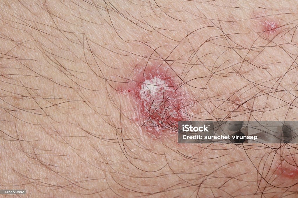 Psoriasis Is An Autoimmune Disease That Affects The Skin Causing Red