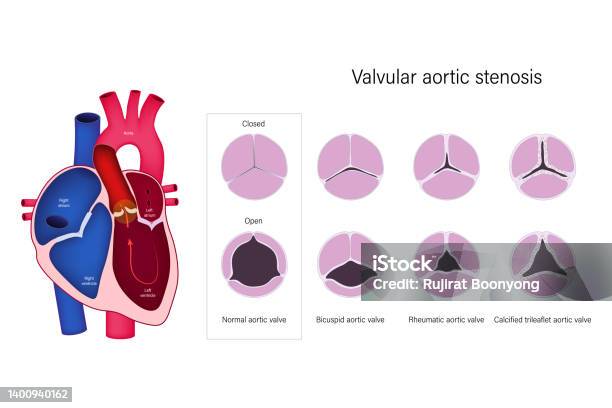 Stenosis Aorta Katup Katup Aorta Normal Katup Aorta Bicuspid Katup ... Stenosis Aorta Katup Katup Aorta Normal Katup Aorta Bicuspid Katup ...