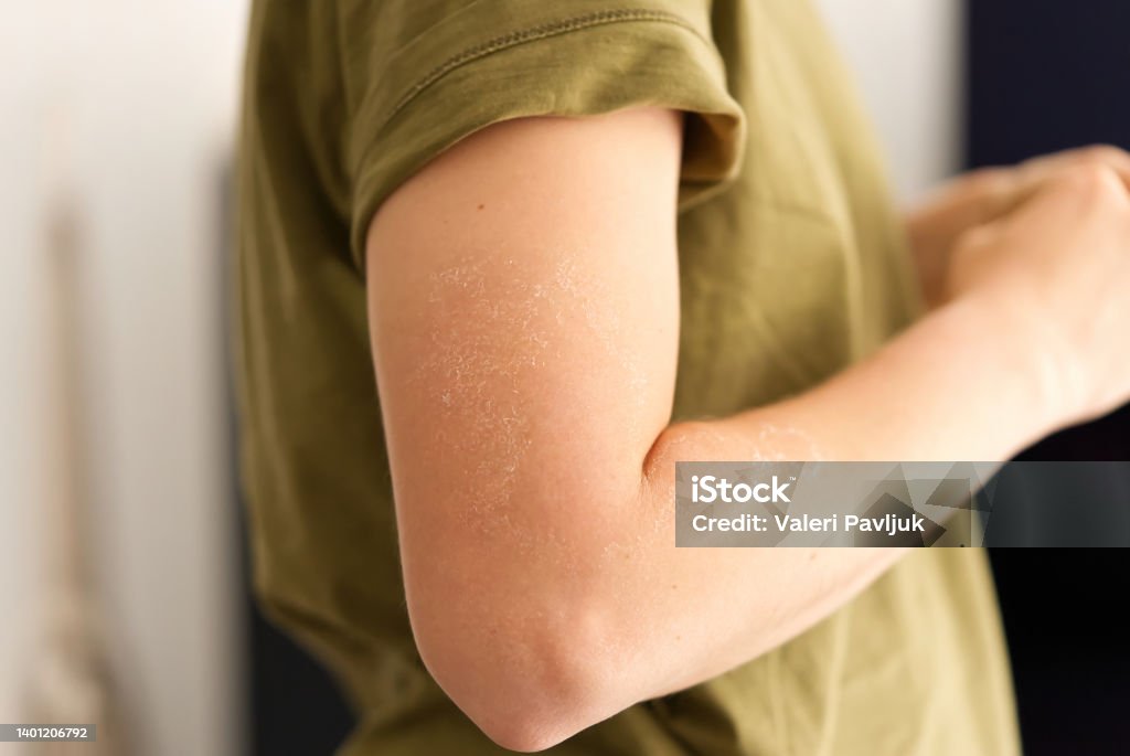 Peeling Skin At Shoulder From Sunburn Effect On Body Of Young Woman