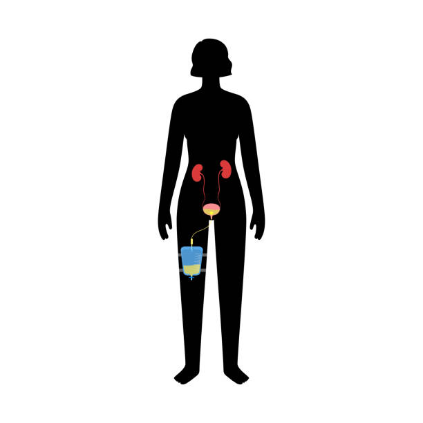 150 Urinary Catheter Stock Illustrations Royalty Free Vector Graphics