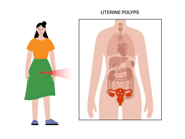 90 Cervical Polyps Stock Illustrations Royalty Free Vector Graphics