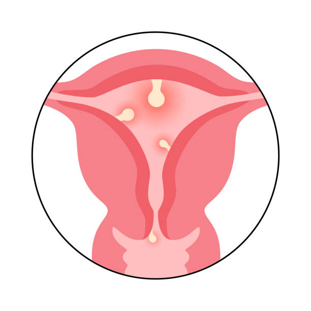 90 Cervical Polyps Stock Illustrations Royalty Free Vector Graphics
