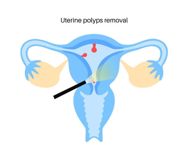 70 Cervical Polyps Stock Illustrations Royalty Free Vector Graphics