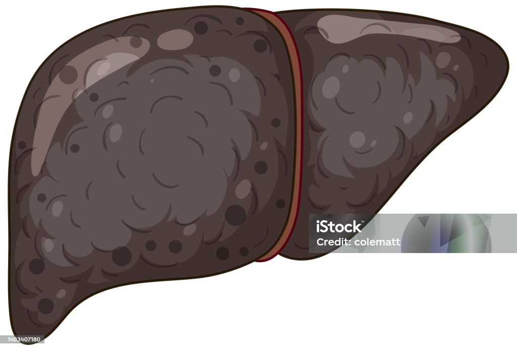 Ilustración De Cirrosis Hepática Sobre Fondo Blanco Y Más Vectores