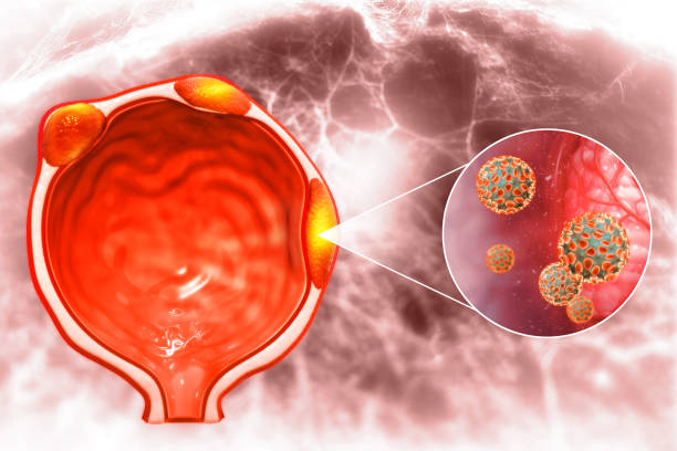 무료 사진: 요도, exudate, neisseria gonorrhoeae 환자, gonococcal, 요도염