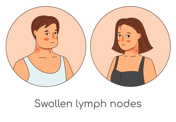 Swollen Cervical Lymph Nodes Swollen Cervical Lymph Nodes