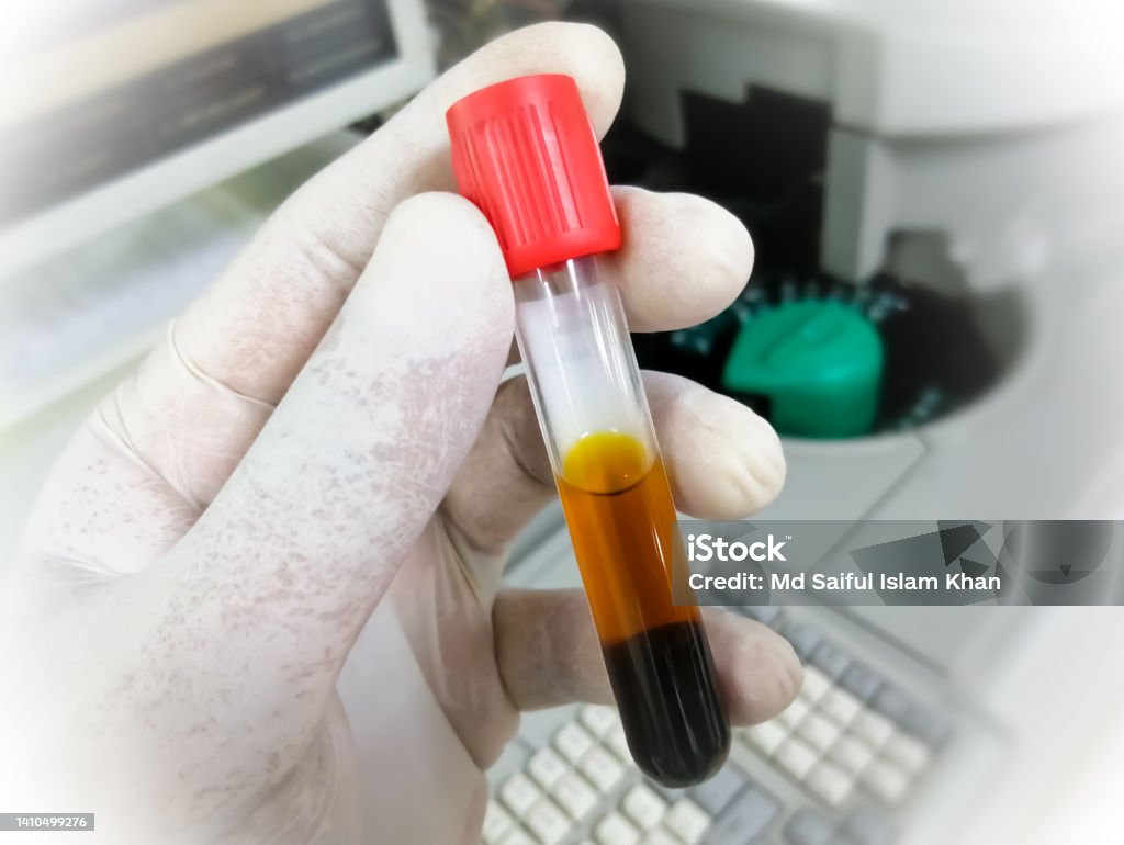Scientist Hold Test Tube With Icteric Serum For Test In Laboratory Hyperbilirubinemia Stock