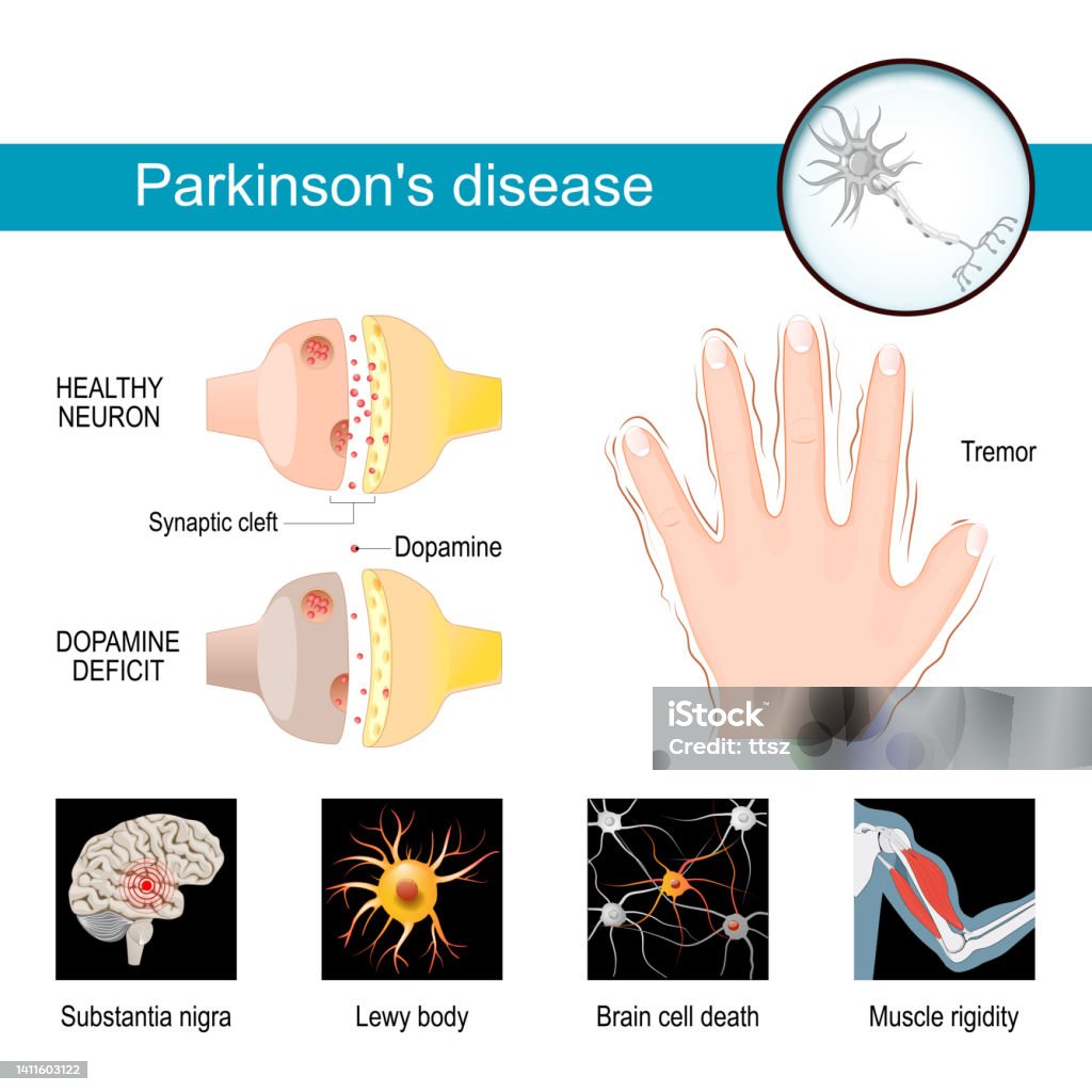 Parkinsonkrankheit Infografik Symptome Eines Parkinsonismus Stock ... Parkinsonkrankheit Infografik Symptome Eines Parkinsonismus Stock ...