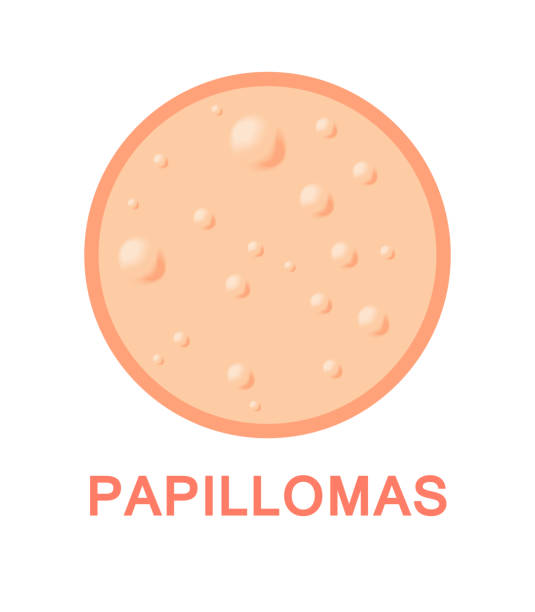 560+ Papiloma Ilustrasi, Grafik Vektor, & Clip Art Bebas Royalti ... 560+ Papiloma Ilustrasi, Grafik Vektor, & Clip Art Bebas Royalti ...