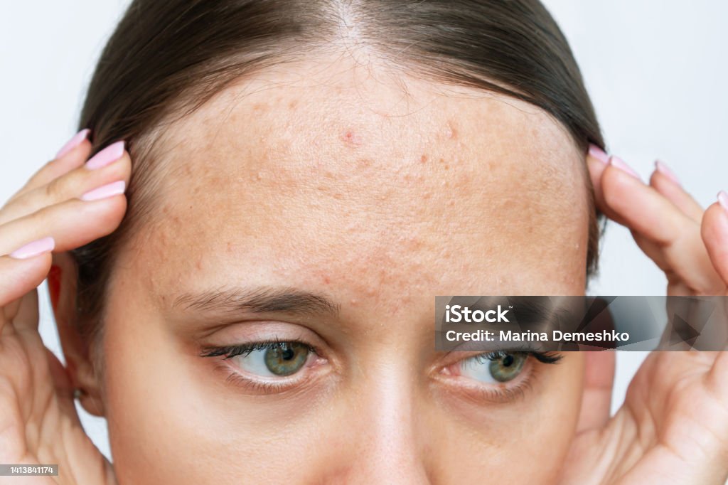Cropped Shot Of Young Womans Face With Acne Problem Red Allergic Rash On The Forehead Stock