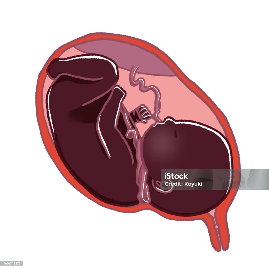 Nuchal Cord The Umbilical Cord Is Wrapped Around The Fetal Neck Stock Illustration Download