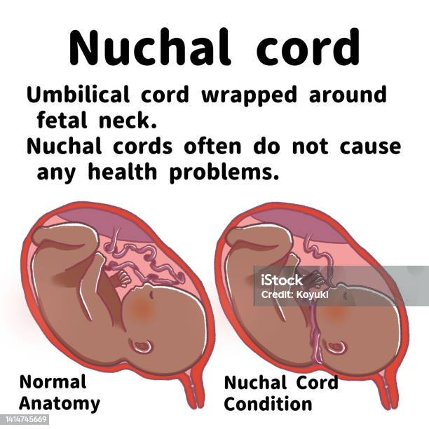 Nuchal Cord Umbilical Cord Wrapped Around Fetal Neck Stock Illustration Download Image Now
