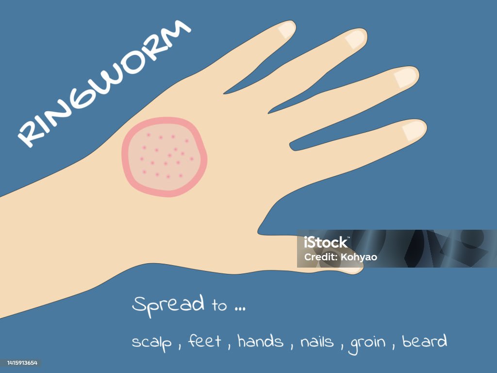 Dermatophytosis Or Ringworm Is Fungal Infection Stock Illustration