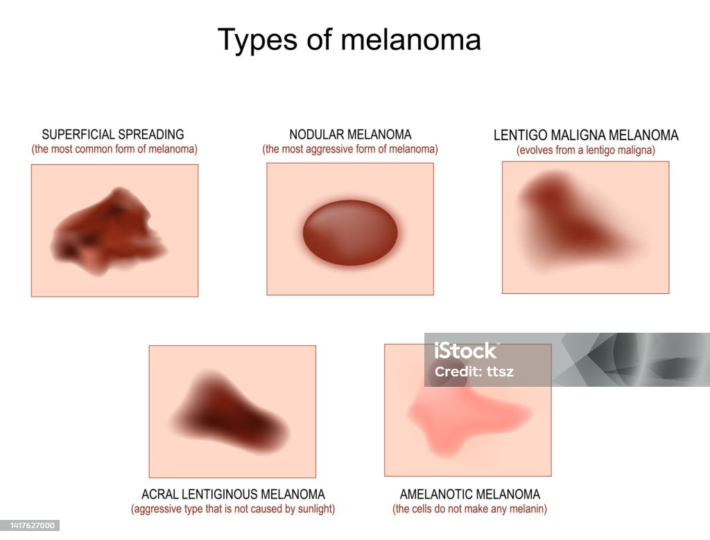 Types Of Melanoma Stock Illustration Download Image Now Skin Cancer Melanoma Typing Istock