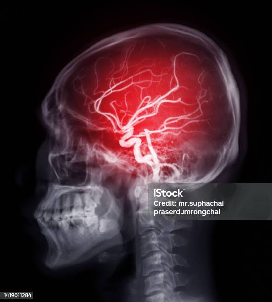 Photo Libre De Droit De Fusion Dimages Du Crâne Avec Irm Mra Brain Pour