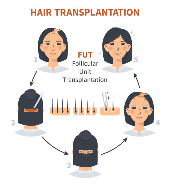 20 Follicular Unit Extraction Stock Illustrations Royalty Free Vector