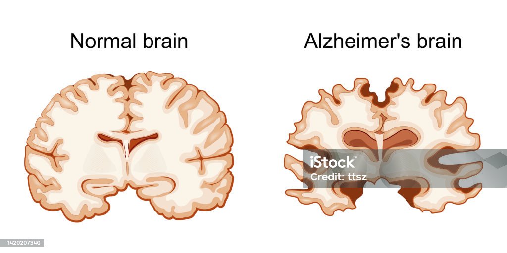 Normal Brain And Alzheimers Brain Stock Illustration - Download Image ... Normal Brain And Alzheimers Brain Stock Illustration - Download Image ...