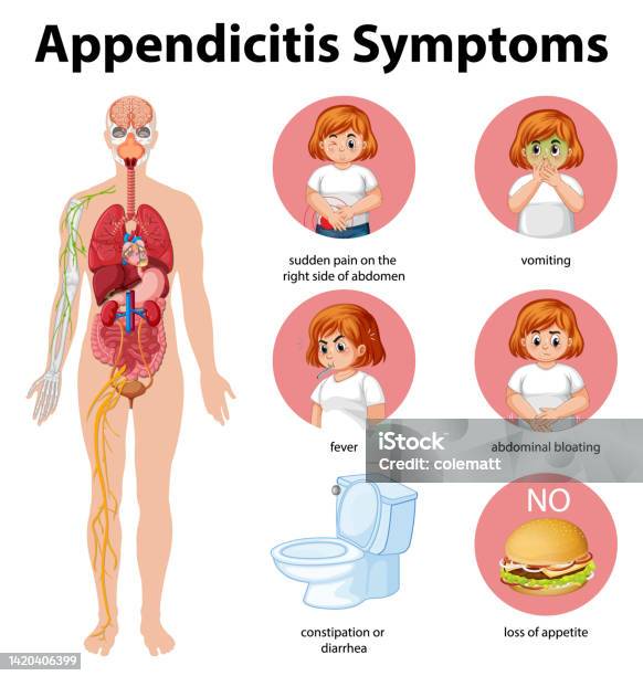 Appendicitis Symptoms Information Infographic Stock Illustration ... Appendicitis Symptoms Information Infographic Stock Illustration ...