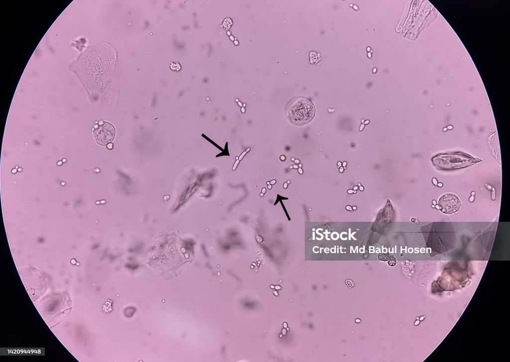 Selsel Ragi Pemula Dalam Urin Pasien Menganalisis Dengan Mikroskop Penyesuaian Kontras Foto Stok