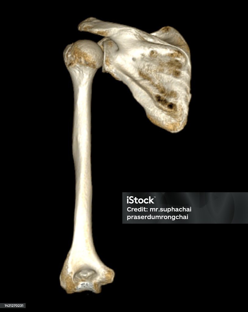Ct Scan Sendi Bahu Dan Tulang Atau Lengan Humerus Foto Stok - Unduh ... Ct Scan Sendi Bahu Dan Tulang Atau Lengan Humerus Foto Stok - Unduh ...