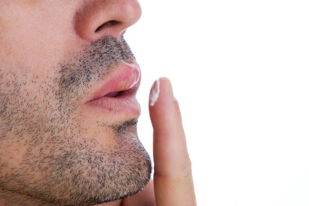 Cold Sore In Nose
