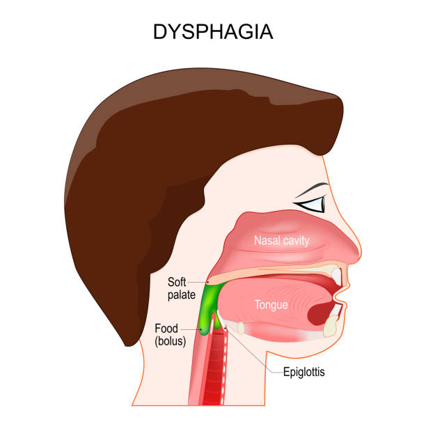 530+ Dysphagia Stock Illustrations, Royalty-Free Vector Graphics & Clip ... 530+ Dysphagia Stock Illustrations, Royalty-Free Vector Graphics & Clip ...