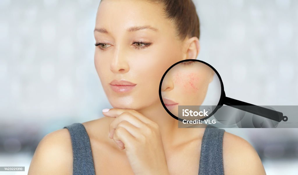 Rosacea Wajah Kemerahan Sebelum Dan Sesudah Foto Stok - Unduh Gambar ... Rosacea Wajah Kemerahan Sebelum Dan Sesudah Foto Stok - Unduh Gambar ...