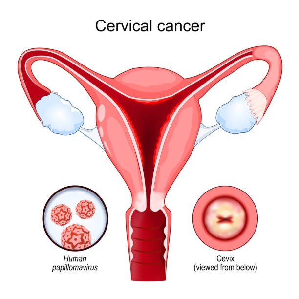190 Cervical Cancer Screening Hpv Stock Illustrations Royalty Free