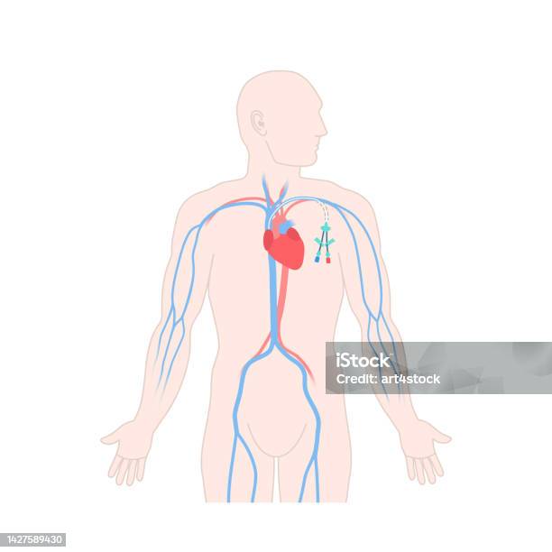 Ilustración de Catéter Venoso De Línea Central Tunelizado En El Cuerpo ... Ilustración de Catéter Venoso De Línea Central Tunelizado En El Cuerpo ...