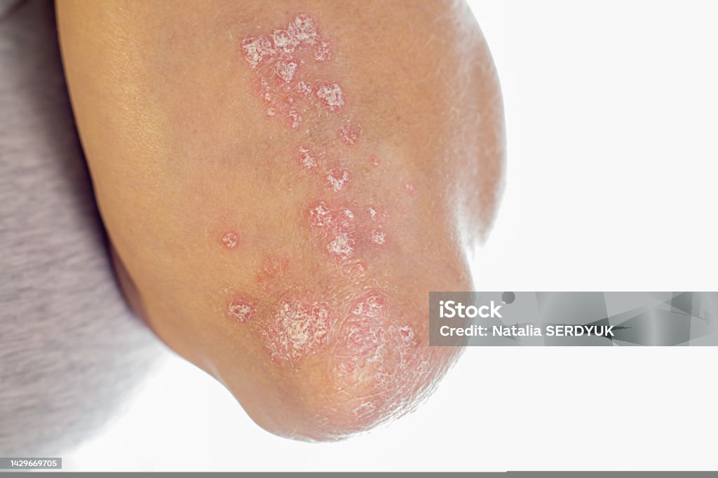 Psoriasis On Elbows Close Up Autoimmune Incurable Dermatological Skin Disease Psoriasis Inflamed