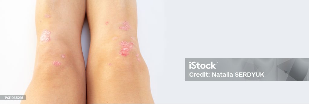 Psoriatic Arthritis With Skin Psoriasis On A Womans Knees Synovial